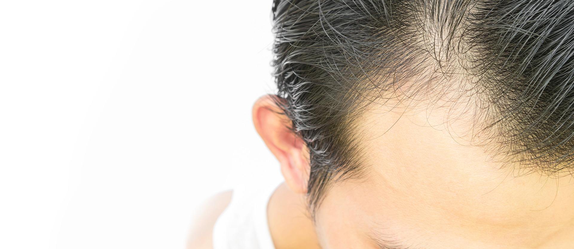 DHT And It's Role In Hair Loss | Elite Hair Loss Solutions